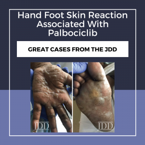 Hand Foot Skin Reaction Associated With Palbociclib - Next Steps in ...