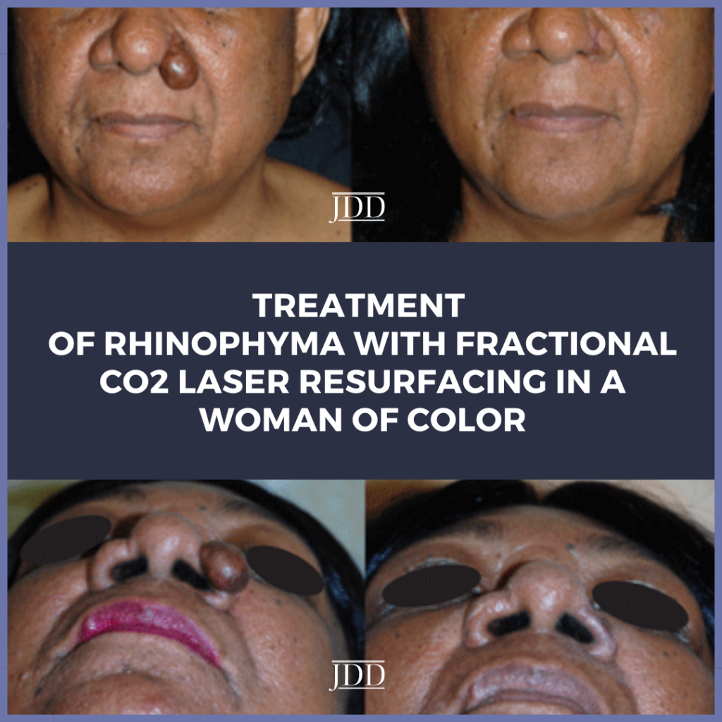 Rhinophyma Treated with Fractional CO2 Laser Resurfacing in a Woman of ...