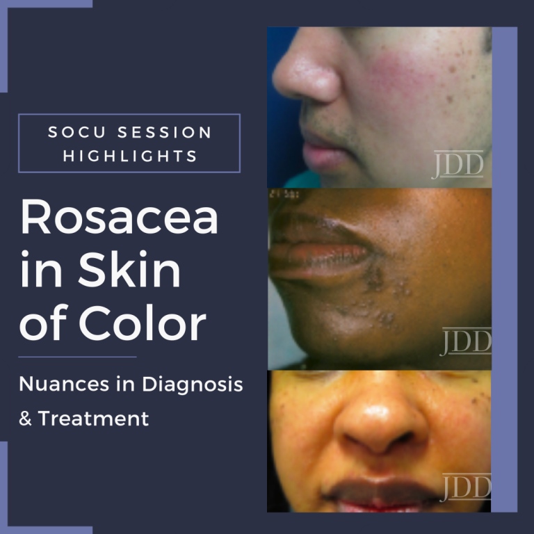 Rosacea in Skin of Color Patients: Nuances in Diagnosis & Treatment ...