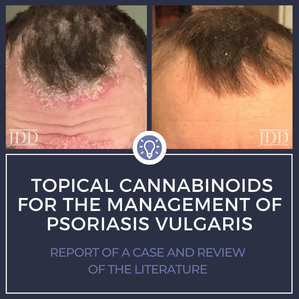 Topical Cannabinoids for the Management of Psoriasis Vulgaris - Next ...