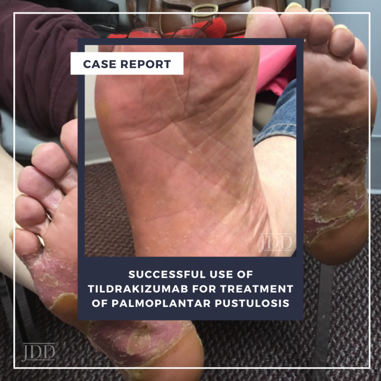 Successful Use of Tildrakizumab for Treatment of Palmoplantar ...