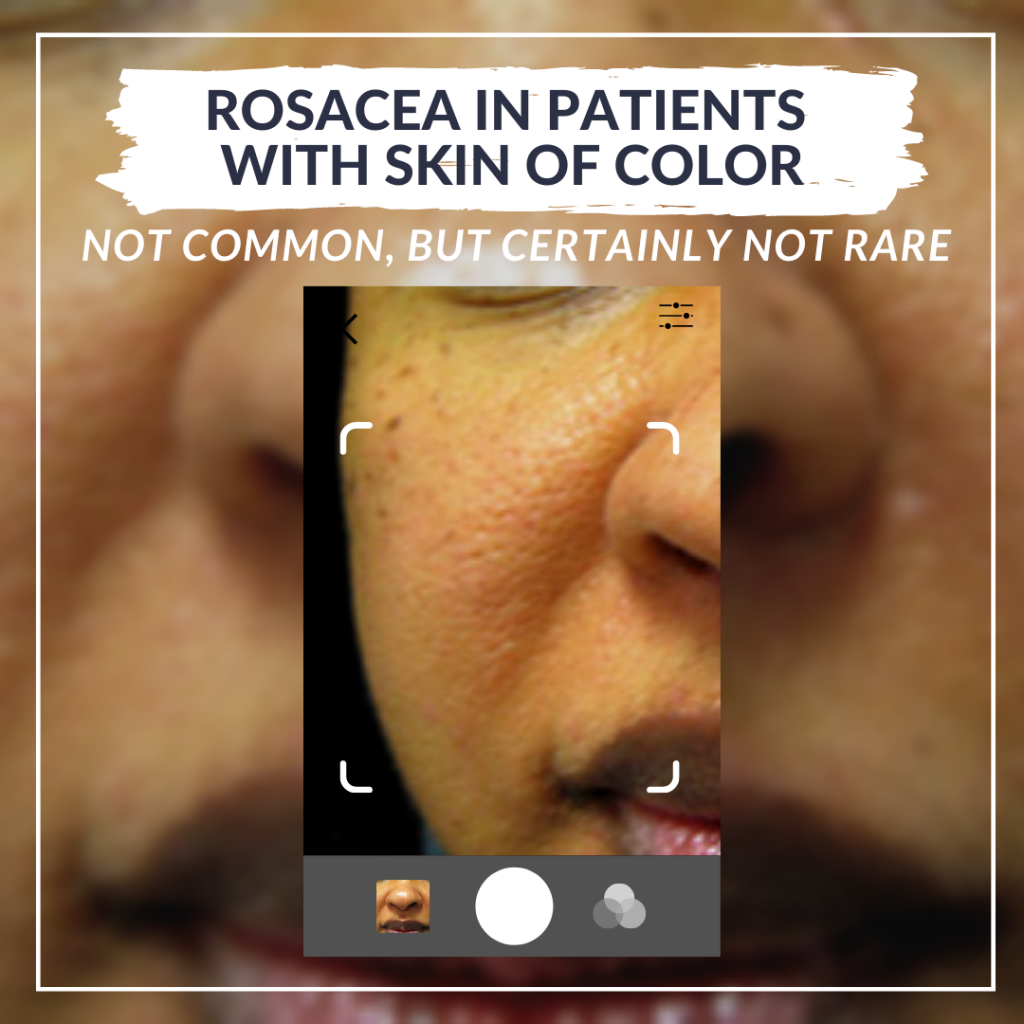 Rosacea in Patients with Skin of Color: Not Common, But Certainly Not ...