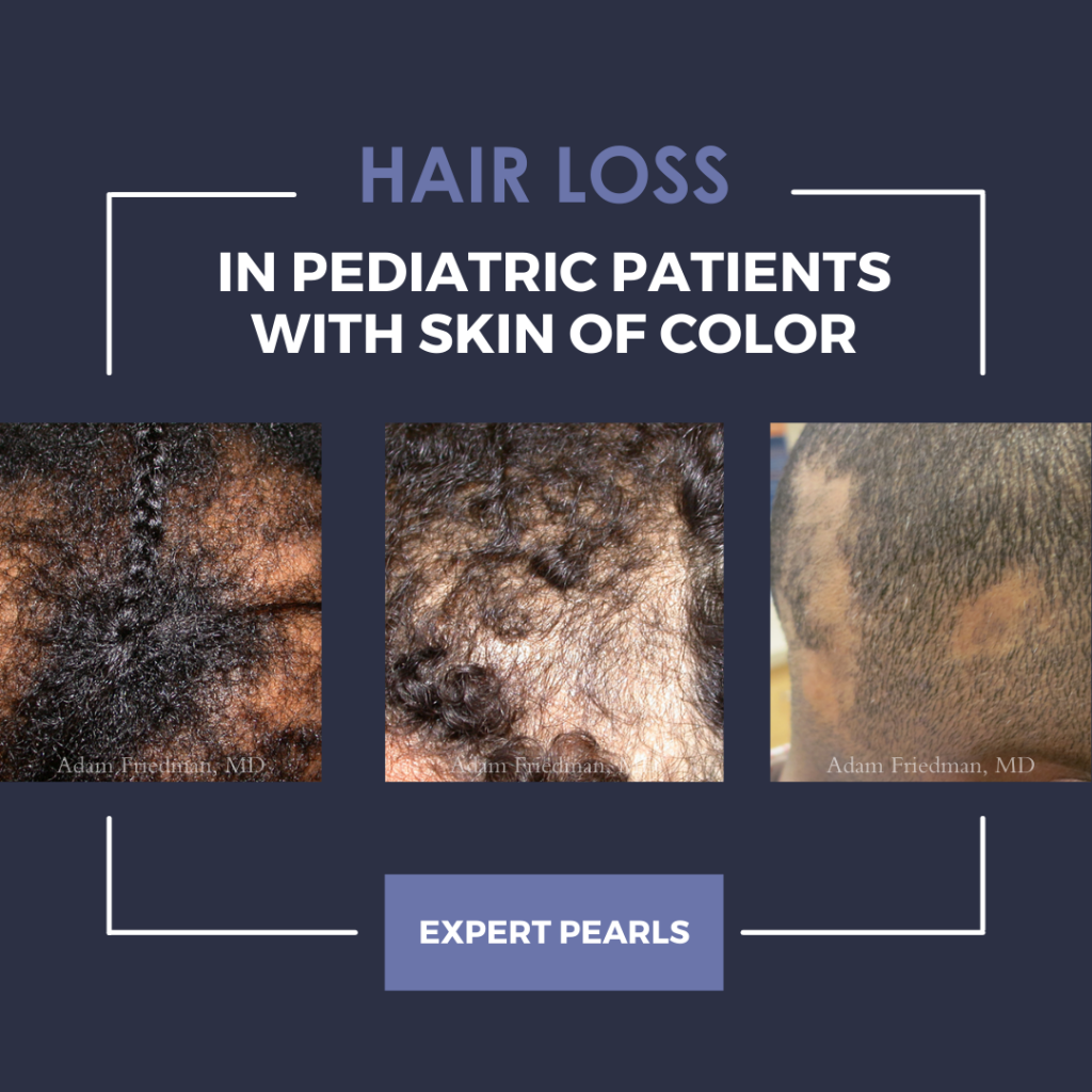 Hair Loss in Pediatric Patients with Skin of Color - Next Steps in ...