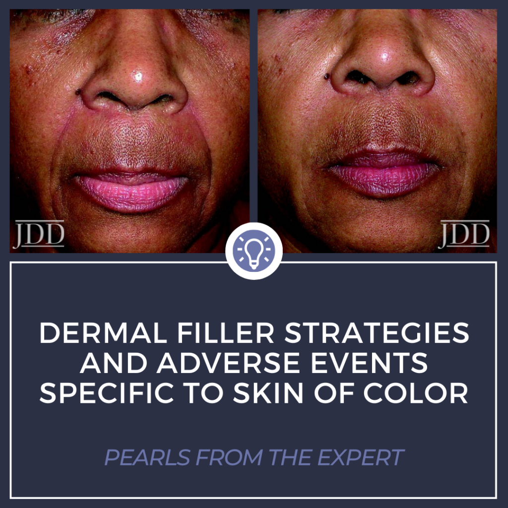 Dermal Filler Strategies and Adverse Events Specific to Skin of Color ...