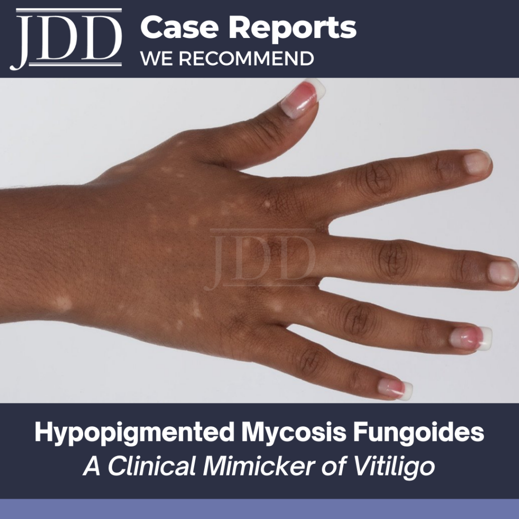 Hypopigmented Mycosis Fungoides: A Clinical Mimicker of Vitiligo - Next ...