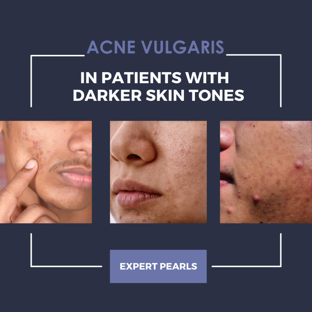 Acne Vulgaris: Nuances in the Approach to Treatment in Patients with ...