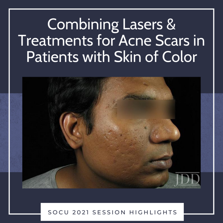 Combining Lasers & Treatments for Acne Scars in Patients with Skin of ...