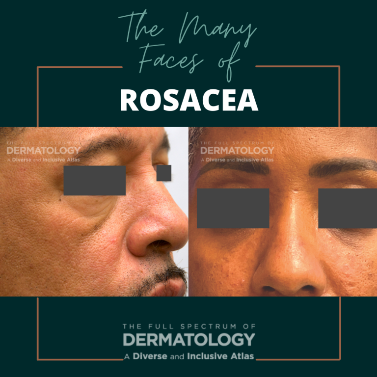 The Many Faces of Rosacea | Part 1 - Next Steps in Dermatology