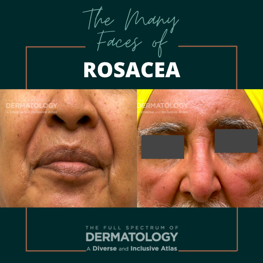 The Many Faces of Rosacea | Part 1 - Next Steps in Dermatology