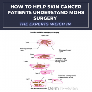How to Help Skin Cancer Patients Understand Mohs Surgery | The Experts ...