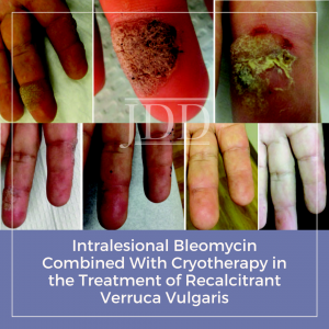 Intralesional Bleomycin Combined With Cryotherapy in the Treatment of ...