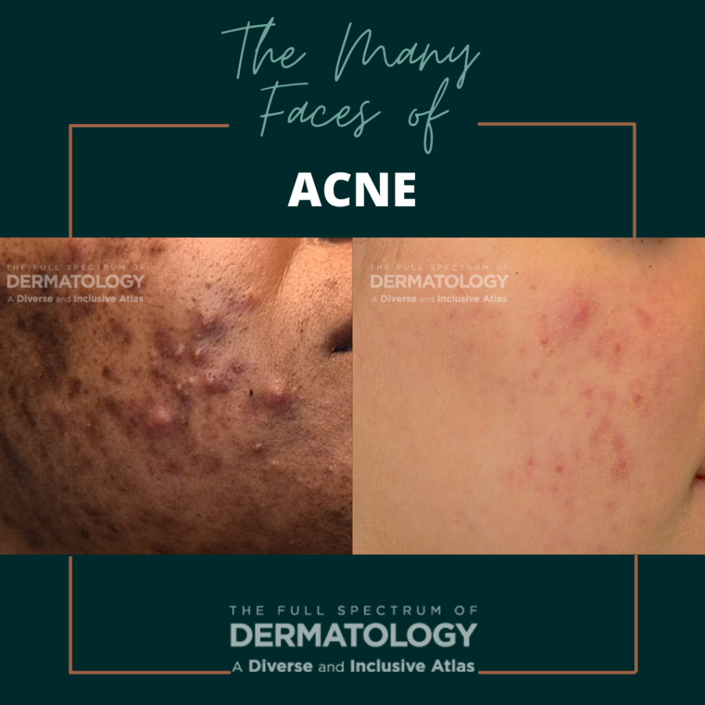 The Many Faces of Acne - Next Steps in Dermatology