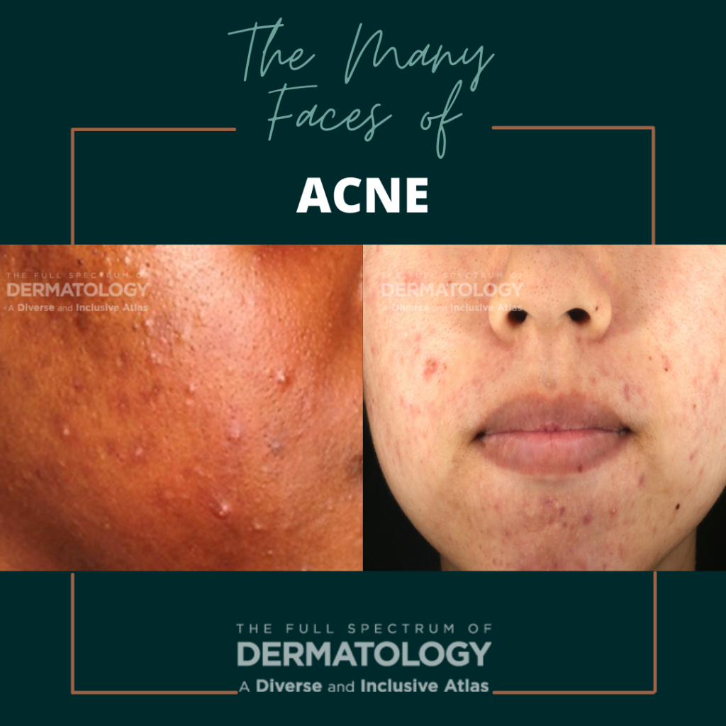 The Many Faces of Acne - Next Steps in Dermatology