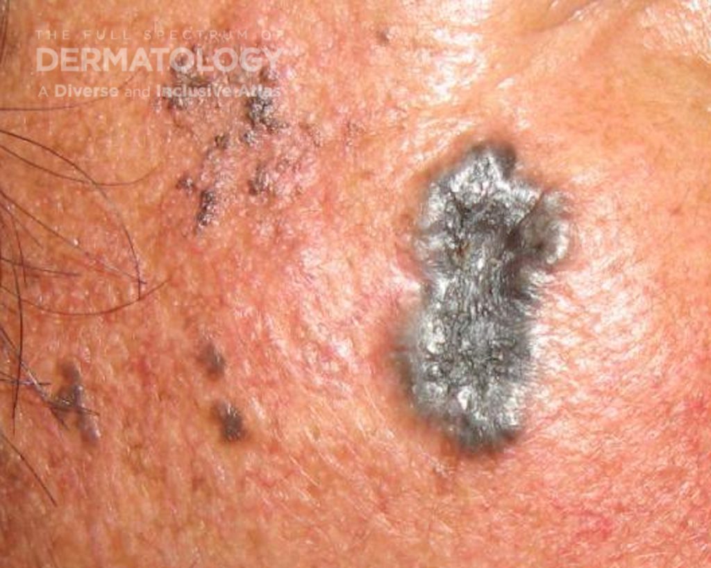 BCC_C_60322 - Next Steps in Dermatology