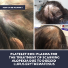 PRP for Scarring Alopecia Due to Discoid Lupus Erythematosus (DLE ...