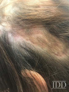 PRP for Scarring Alopecia Due to Discoid Lupus Erythematosus (DLE ...