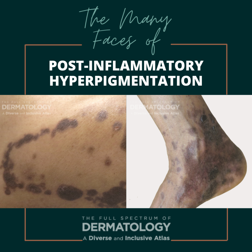 The Many Faces of Post-Inflammatory Hyperpigmentation (PIH) - Next ...