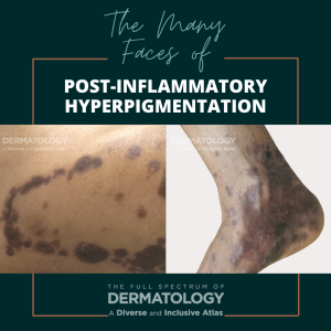 The Many Faces of Post-Inflammatory Hyperpigmentation (PIH) - Next ...