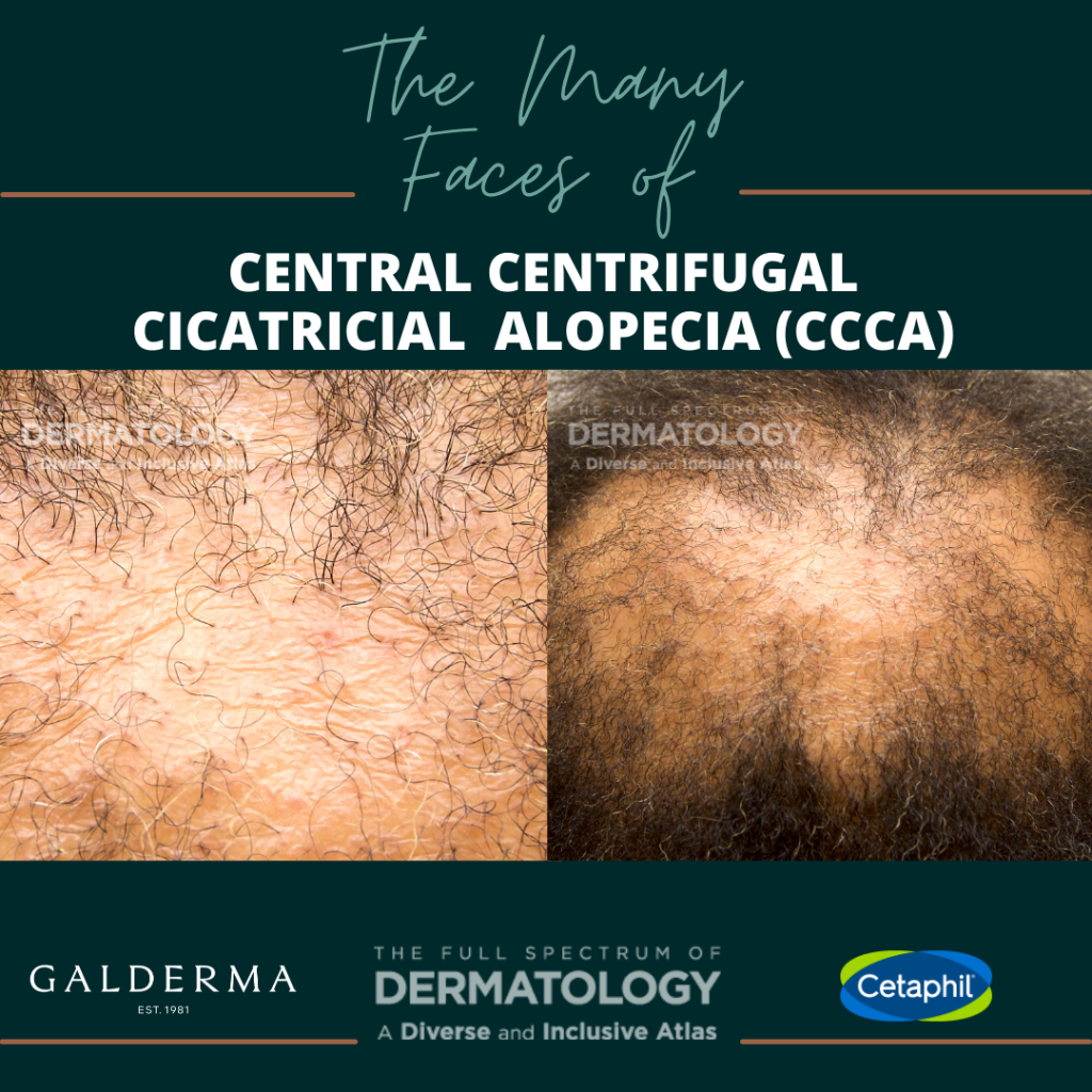 The Many Faces of Central Centrifugal Cicatricial Alopecia (CCCA ...