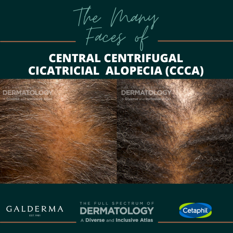 The Many Faces of Central Centrifugal Cicatricial Alopecia (CCCA ...