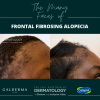 The Many Faces of Frontal Fibrosing Alopecia (FFA) - Next Steps in ...