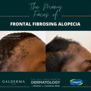 The Many Faces of Frontal Fibrosing Alopecia (FFA) - Next Steps in ...