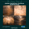 The Many Faces of Central Centrifugal Cicatricial Alopecia (CCCA ...