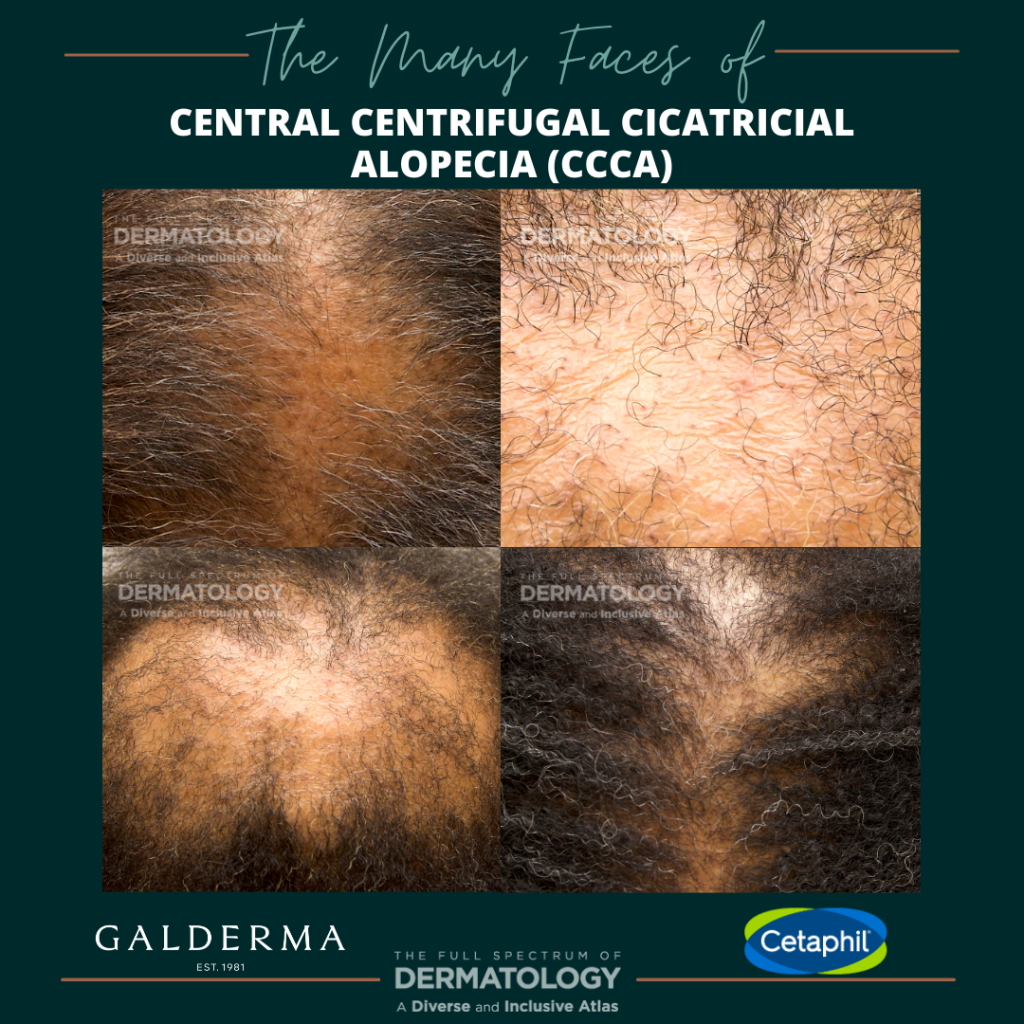 The Many Faces of Central Centrifugal Cicatricial Alopecia (CCCA) - Next Steps in Dermatology