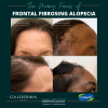 The Many Faces of Frontal Fibrosing Alopecia (FFA) - Next Steps in ...