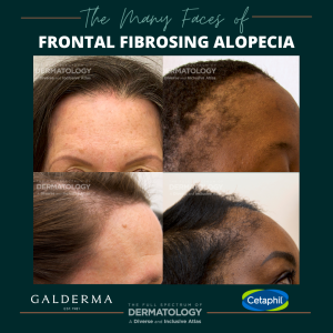 The Many Faces of Frontal Fibrosing Alopecia (FFA) - Next Steps in ...