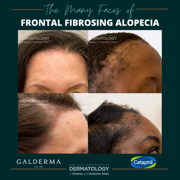 The Many Faces Of Frontal Fibrosing Alopecia Ffa Next Steps In Dermatology
