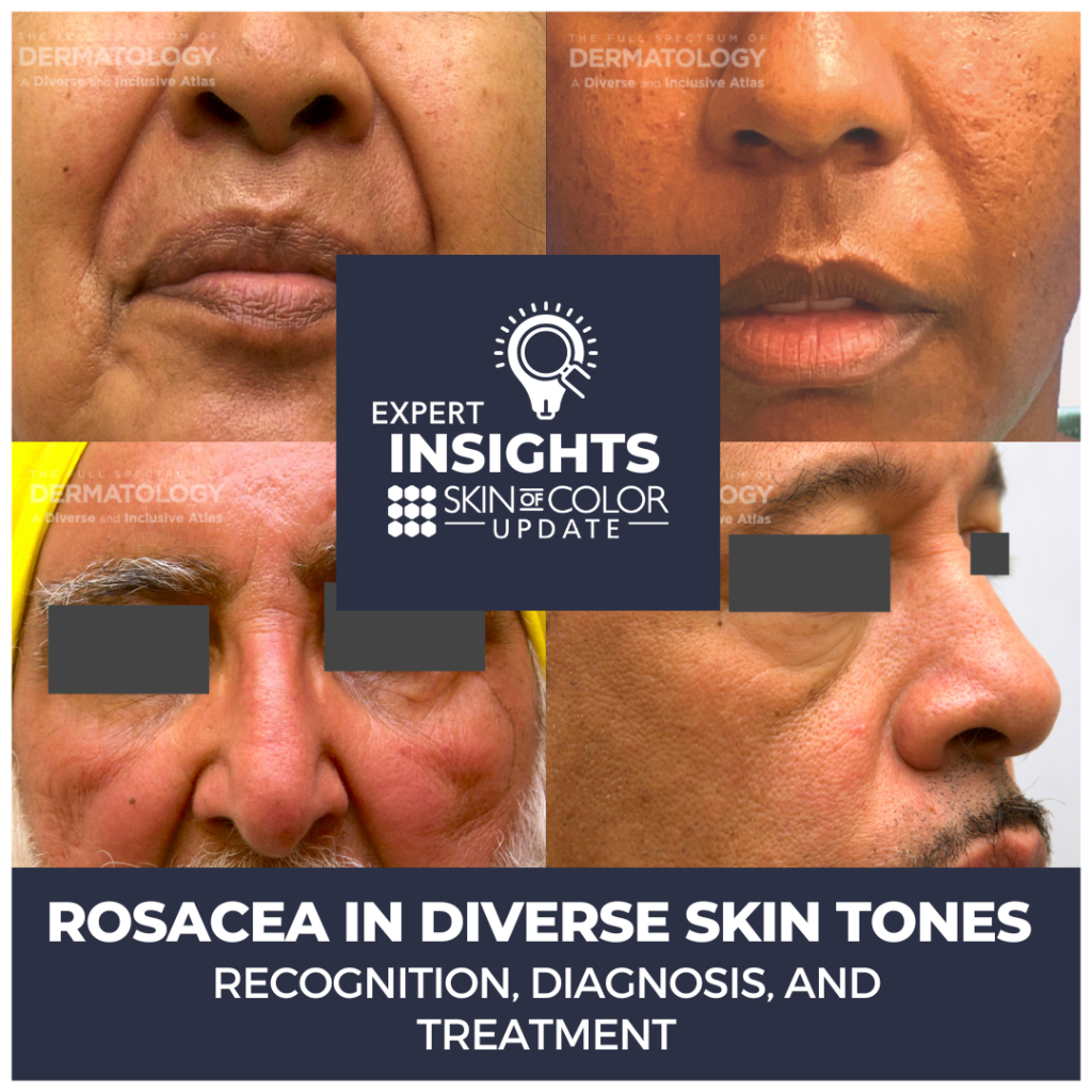 Rosacea in Diverse Skin Tones | Recognition, Diagnosis, and Treatment ...