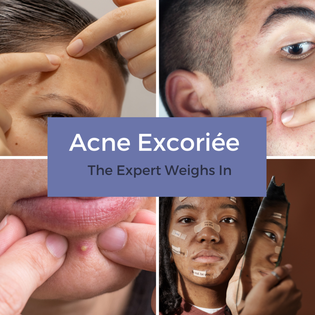 Patient Buzz: Acne Excoriée | The Expert Weighs In - Next Steps in ... Patient Buzz: Acne Excoriée | The Expert Weighs In - Next Steps in ...