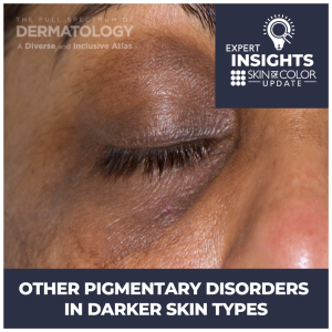 Other Pigmentary Disorders in Darker Skin Types - Next Steps in Dermatology