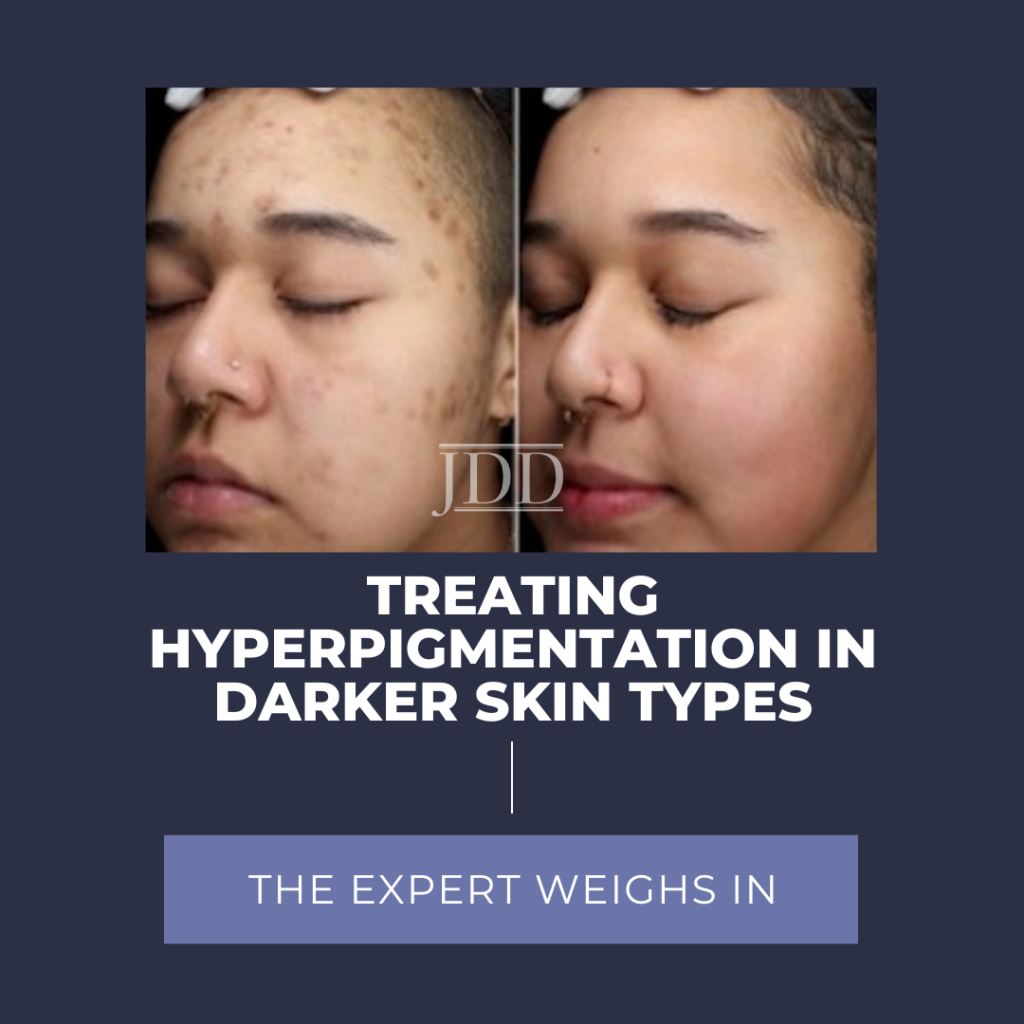 Treating Hyperpigmentation in Darker Skin Types: The Expert Weighs In ...