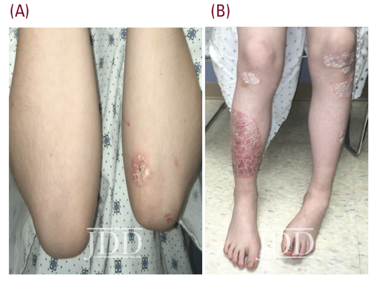 Severe Psoriasis Presenting in 3-Year-Old Child With Nail Dystrophy ...