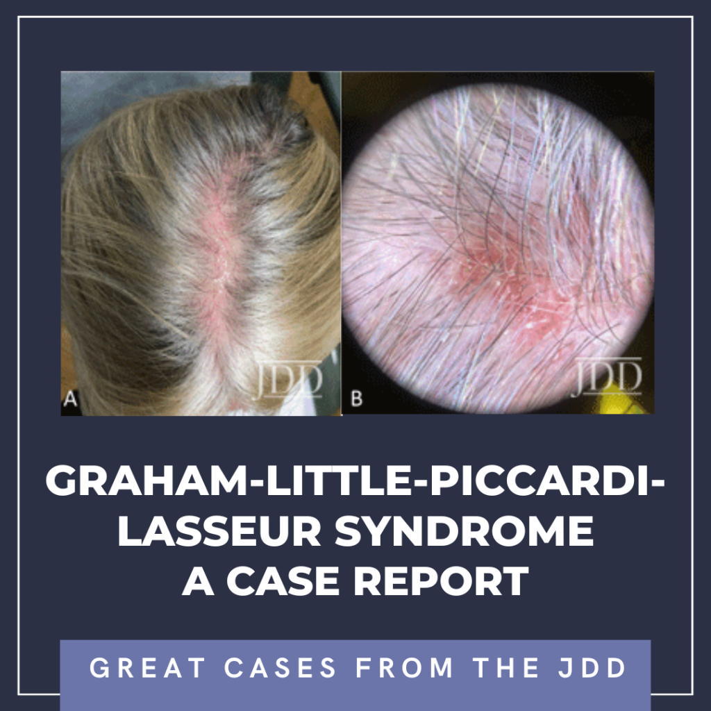 Graham-Little-Piccardi-Lasseur Syndrome: A Case Report - Next Steps in ...