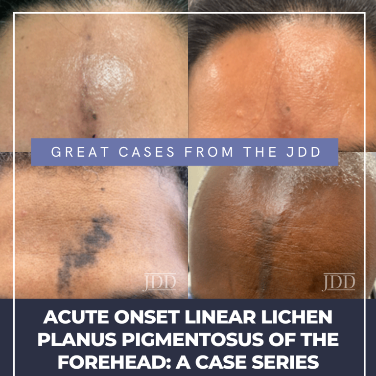 Acute Onset Linear Lichen Planus Pigmentosus of the Forehead: A Case ...