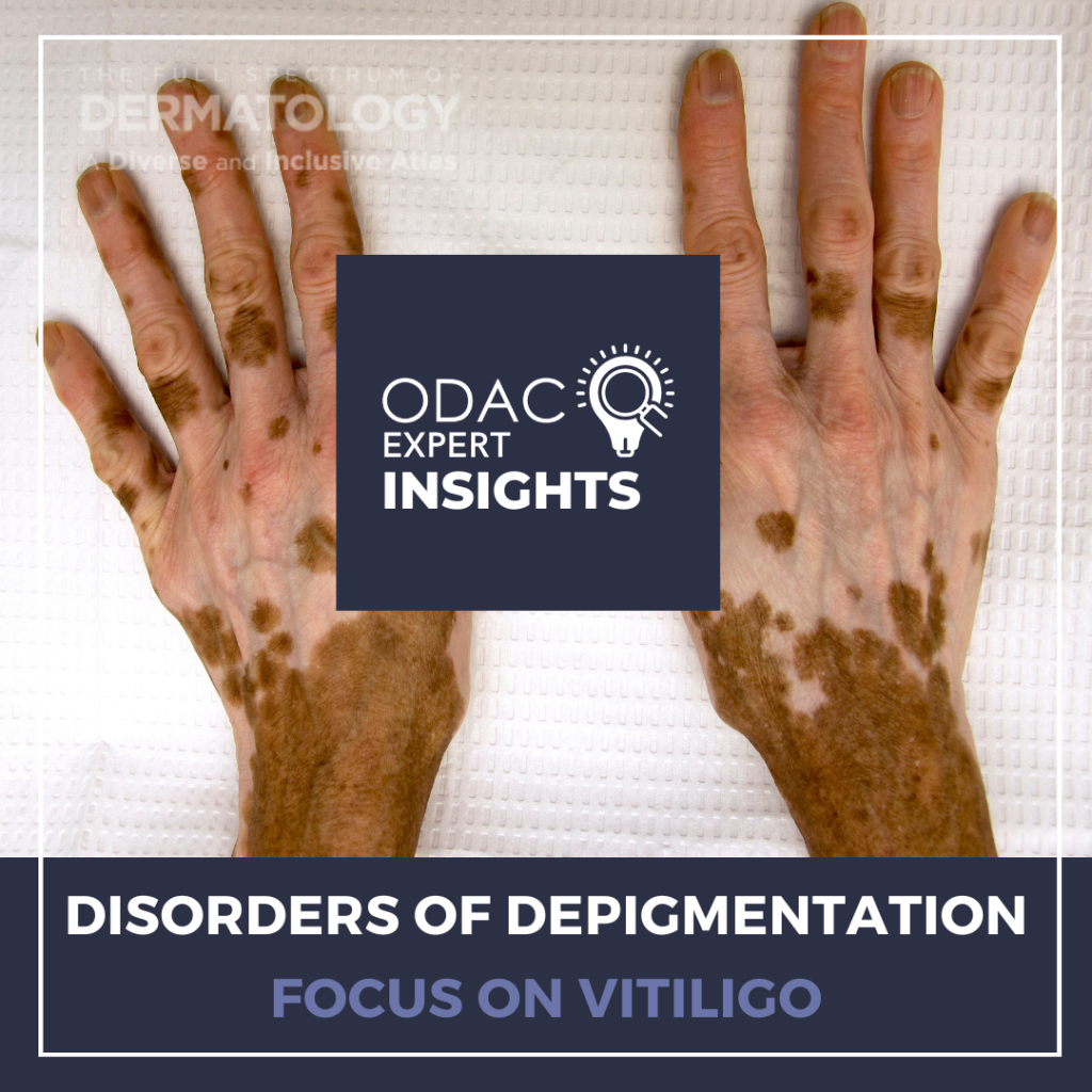 Disorders of Depigmentation: Focus on Vitiligo - Next Steps in Dermatology