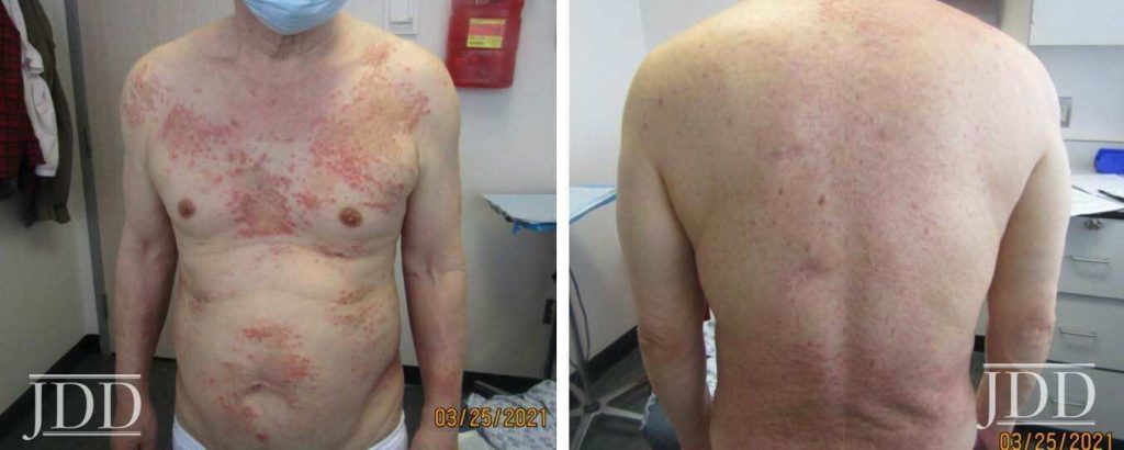 Dermal Hypersensitivity Reaction to Semaglutide: Two Case Reports ...
