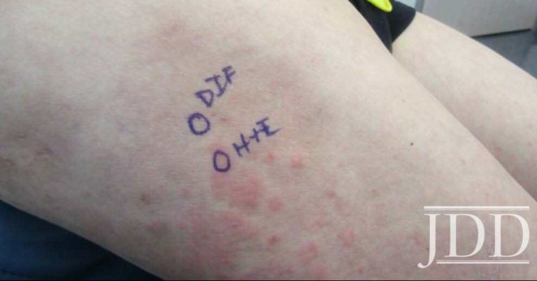 Dermal Hypersensitivity Reaction to Semaglutide: Two Case Reports ...