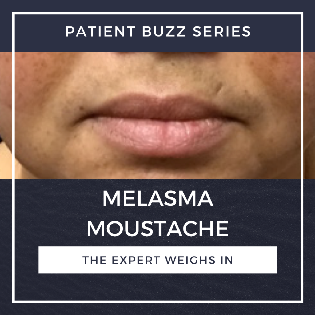 Patient Buzz: Melasma Moustache | The Expert Weighs In - Next Steps in ...