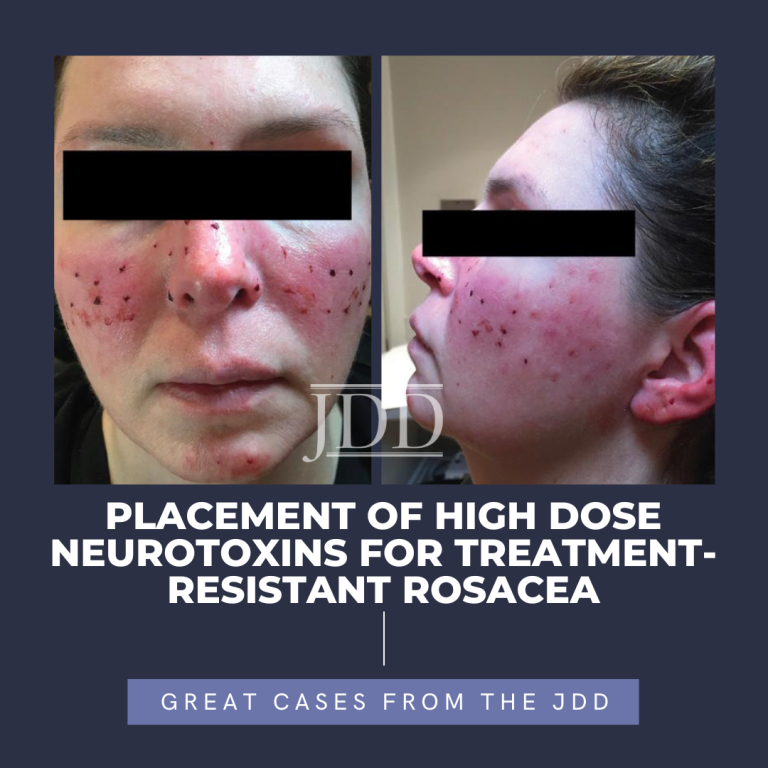 Placement of High Dose Neurotoxins for Treatment-Resistant Rosacea ...