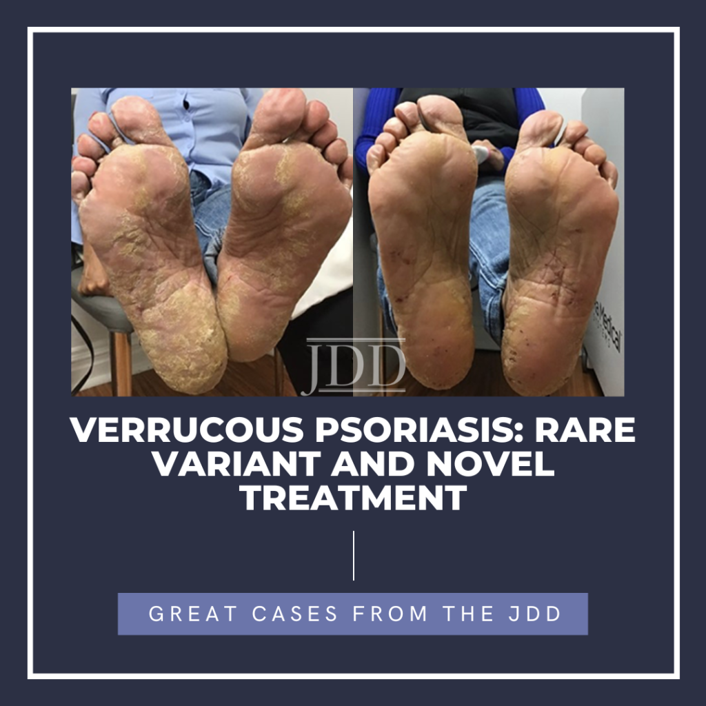 Verrucous Psoriasis: Rare Variant and Novel Treatment - Next Steps in ...