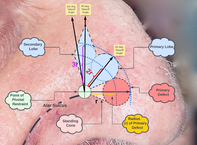 Bilobed Flap Therapeutic Cheat Sheet - Next Steps in Dermatology