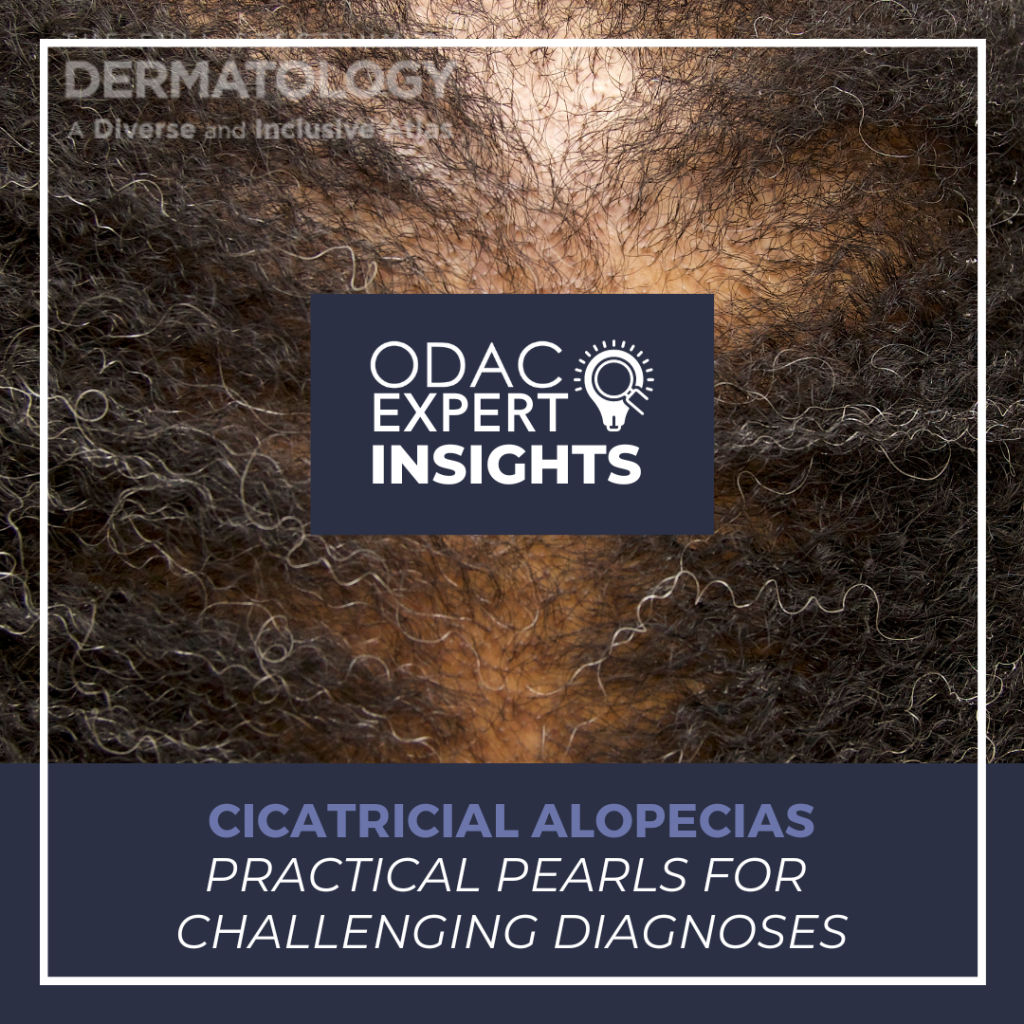 Central Centrifugal Cicatricial Alopecia (CCCA) Archives - Next Steps ...