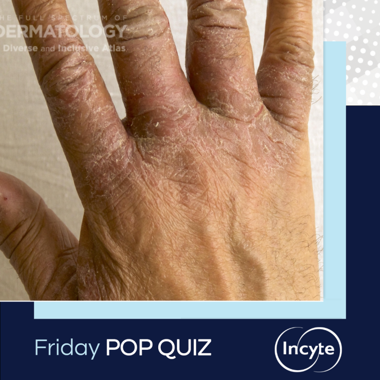 Atopic Dermatitis - Friday Pop Quiz 11/3/2023 - Next Steps in Dermatology