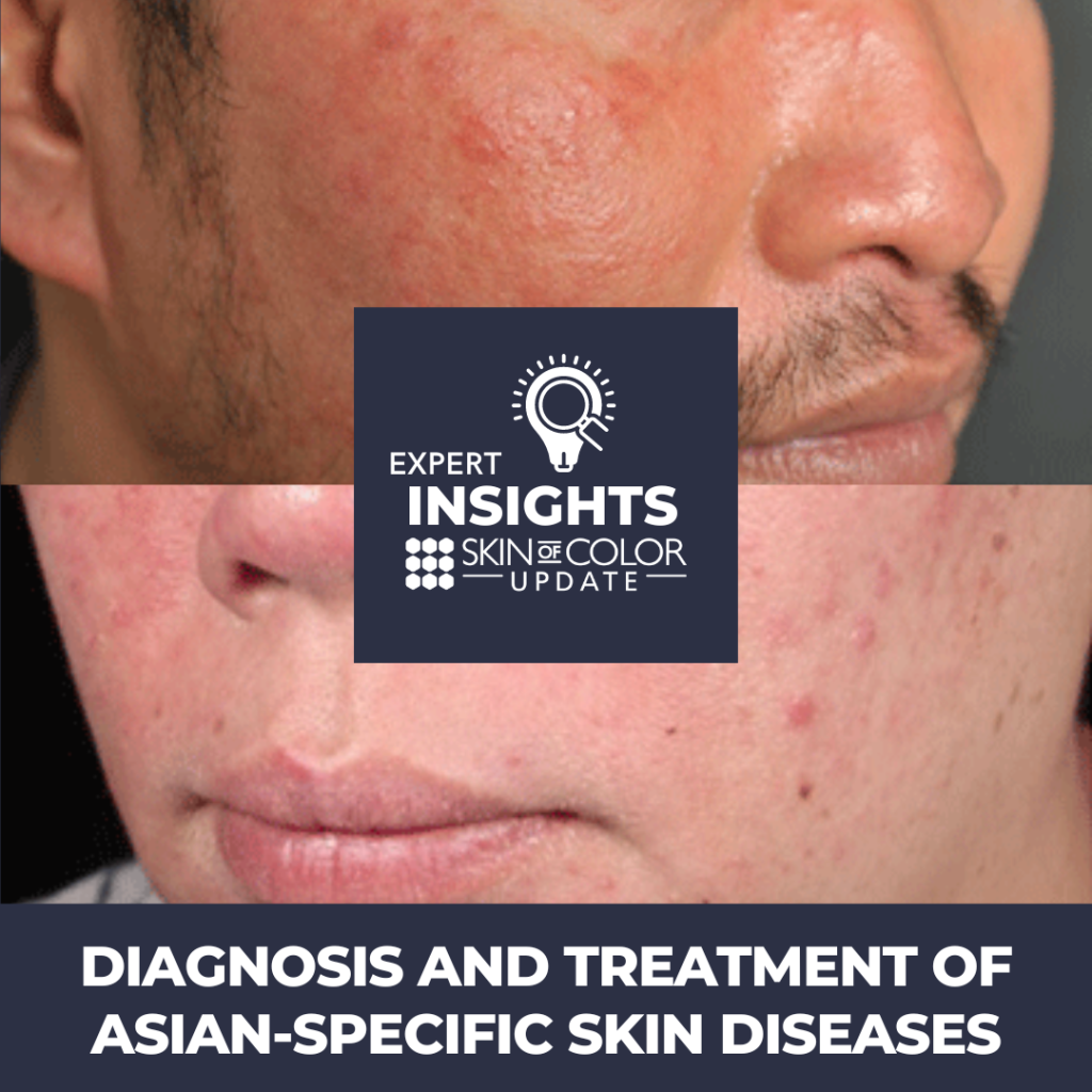Diagnosis and Treatment of Asian-Specific Skin Diseases - Next Steps in ...