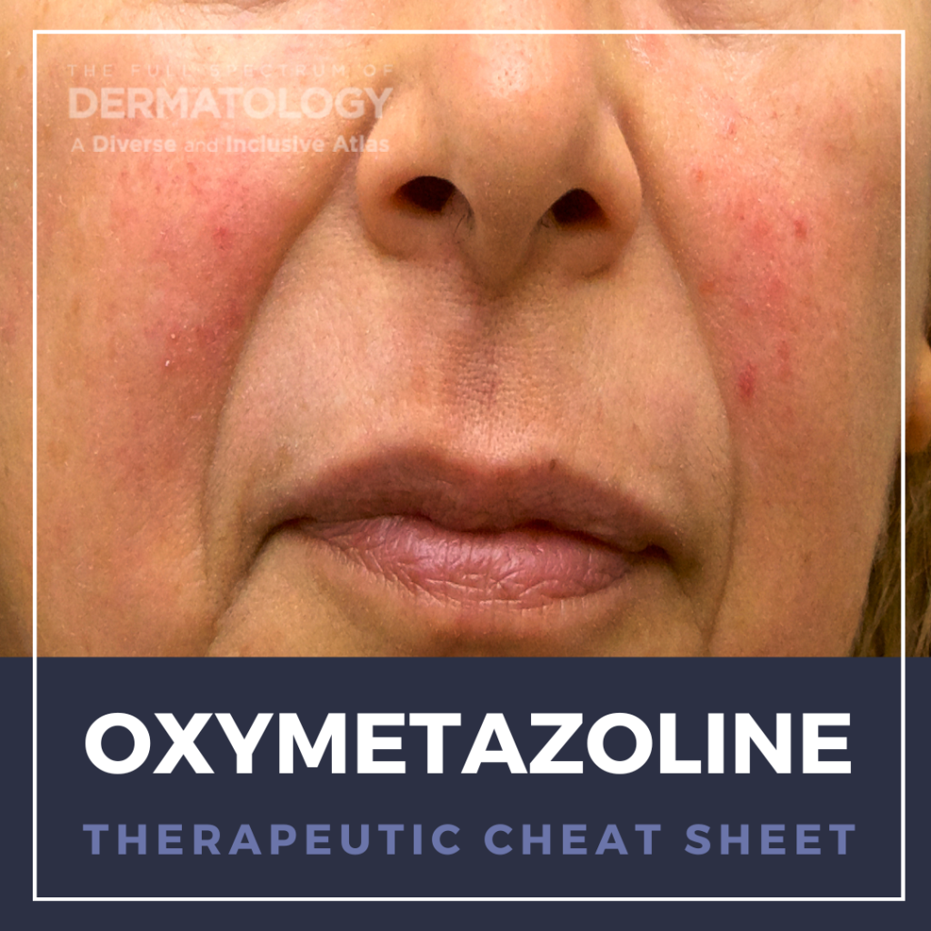 Oxymetazoline Therapeutic Cheat Sheet - Next Steps in Dermatology