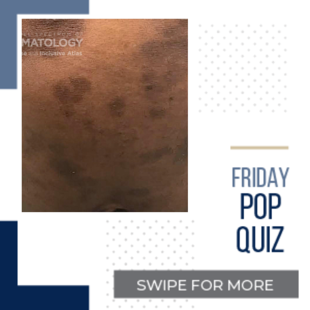 Derm In-Review Archives - Page 2 of 74 - Next Steps in Dermatology